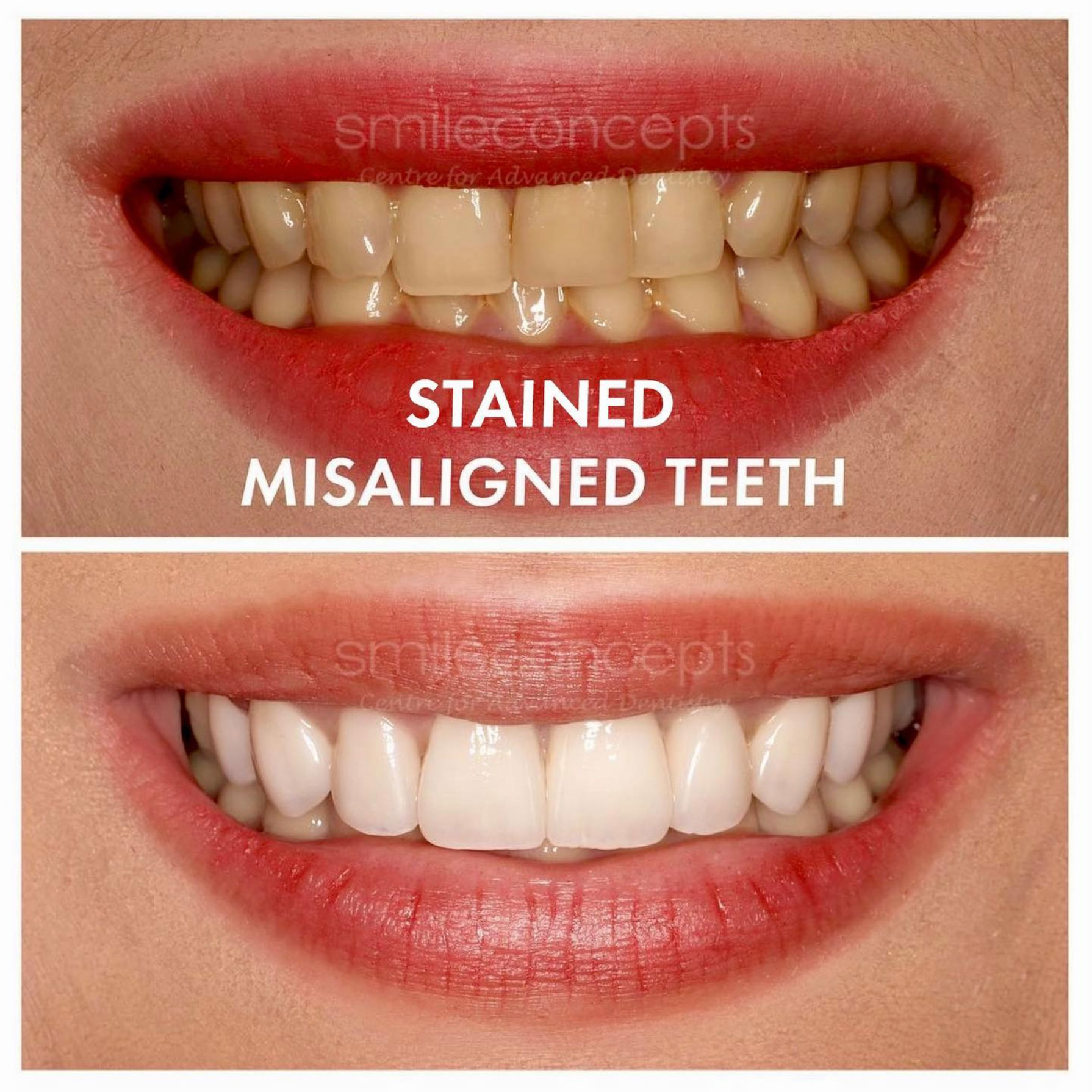 Porcelain Veneers Sydney | Best Affordable Dental Veneers Sydney CBD
